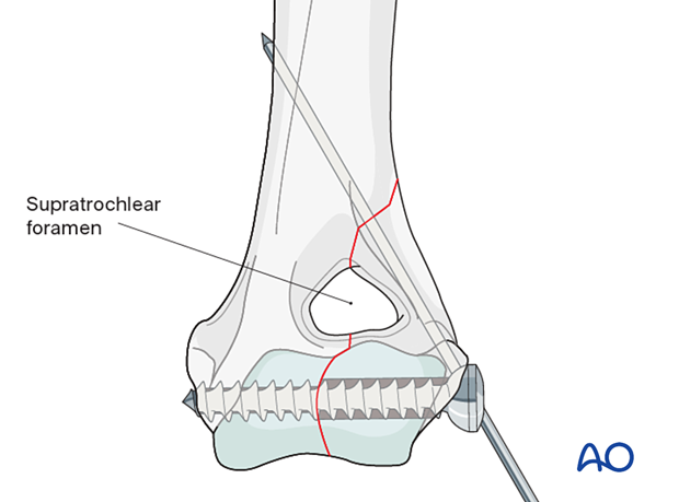 Transcondylar screw and antirotational pin for Lateral partial ...