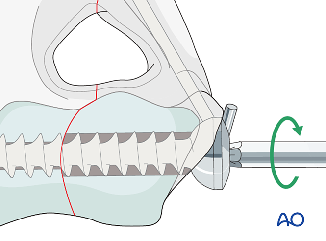 Transcondylar screw and antirotational pin for Lateral partial ...