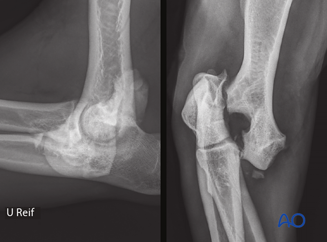 Transcondylar screw and antirotational pin for Lateral partial ...
