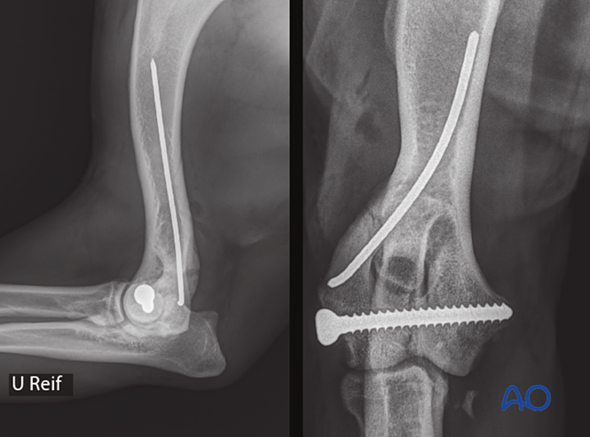 Transcondylar screw and antirotational pin for Lateral partial ...