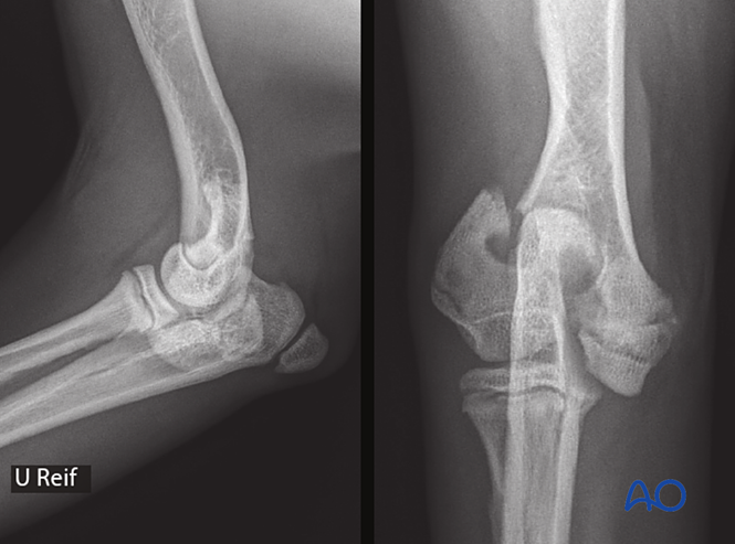 Transcondylar screw and antirotational pin for Lateral partial ...
