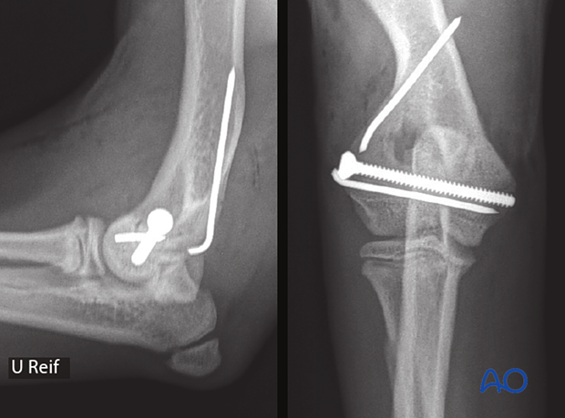 Transcondylar screw and antirotational pin for Lateral partial ...