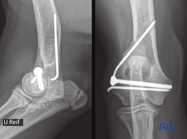 Transcondylar screw and antirotational pin for Lateral partial ...