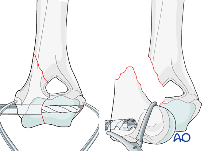 Transcondylar screw and plating of epicondylar crest for Introduction
