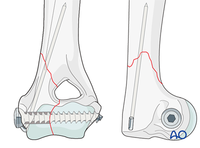 Transcondylar screw and antirotational pin for Medial partial articular ...