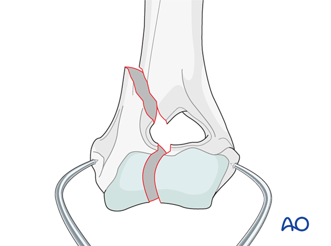 Transcondylar screw and plating of epicondylar crest for Introduction