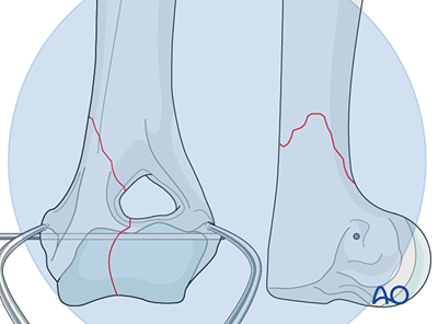 Transcondylar screw and plating of epicondylar crest for Introduction