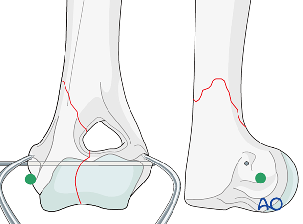 Transcondylar screw and plating of epicondylar crest for Introduction