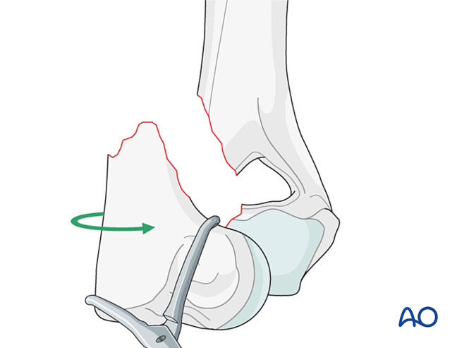 Transcondylar screw and plating of epicondylar crest for Introduction