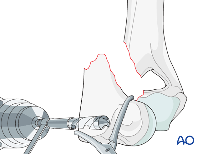 Transcondylar screw and antirotational pin for Medial partial articular ...