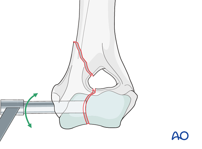 Transcondylar screw and plating of epicondylar crest for Introduction