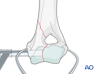 Transcondylar screw and plating of epicondylar crest for Introduction