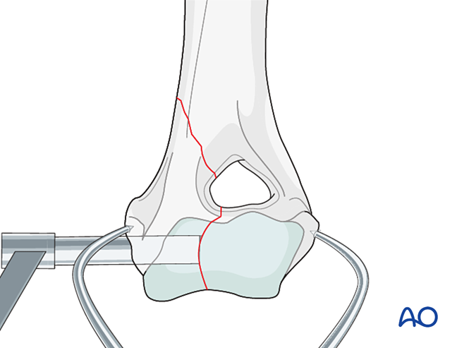 Transcondylar screw and antirotational pin for Medial partial articular ...