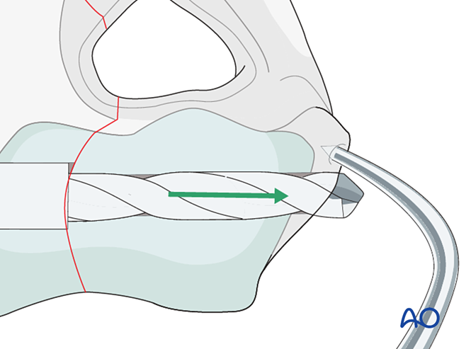 Transcondylar screw and plating of epicondylar crest for Introduction