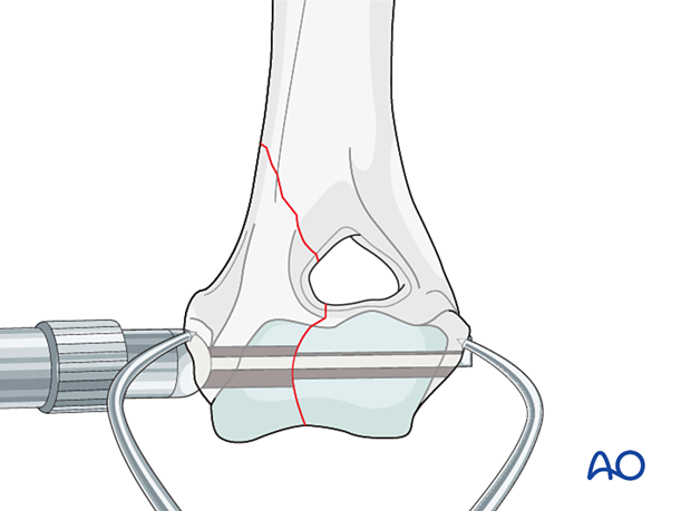 Transcondylar screw and antirotational pin for Medial partial articular ...