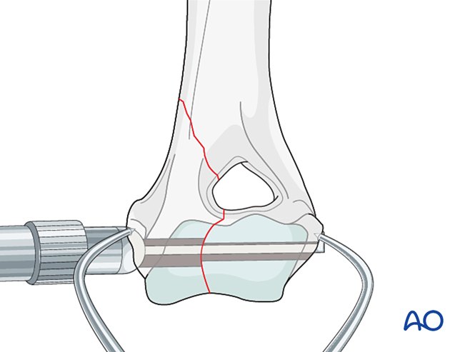 Transcondylar screw and plating of epicondylar crest for Introduction