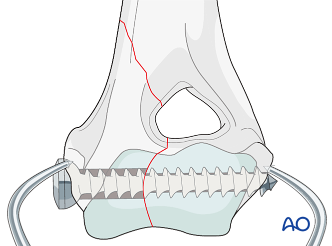 Transcondylar screw and plating of epicondylar crest for Introduction