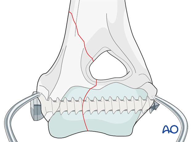 Transcondylar screw and antirotational pin for Medial partial articular ...