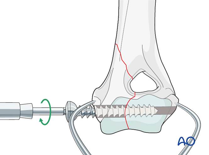 Transcondylar screw and antirotational pin for Medial partial articular ...