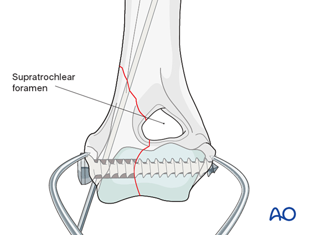 Transcondylar screw and antirotational pin for Medial partial articular ...