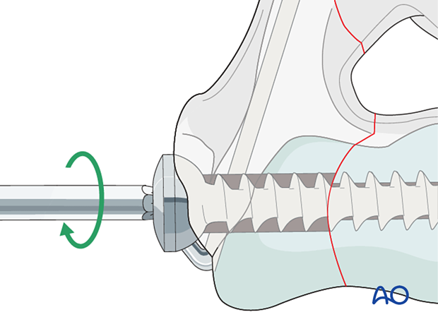 Transcondylar screw and antirotational pin for Medial partial articular ...