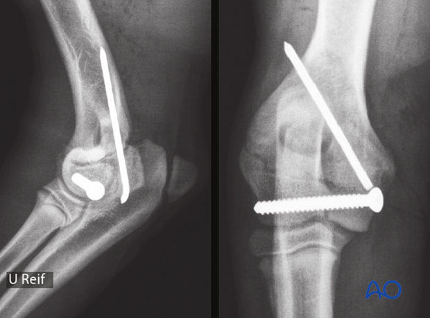 Transcondylar screw and antirotational pin for Medial partial articular ...