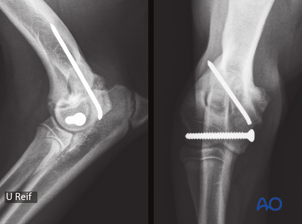 Transcondylar screw and antirotational pin for Medial partial articular ...