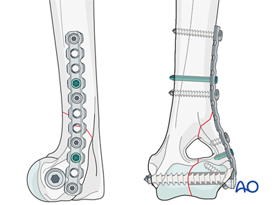 Transcondylar screw and plating of the epicondylar crest for Lateral ...