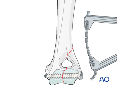 Transcondylar screw and plating of the epicondylar crest for Lateral ...