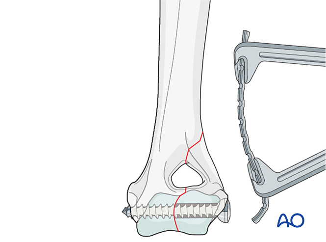 Transcondylar screw and plating of the epicondylar crest for Lateral ...