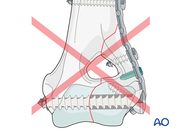 Transcondylar screw and plating of the epicondylar crest for Lateral ...