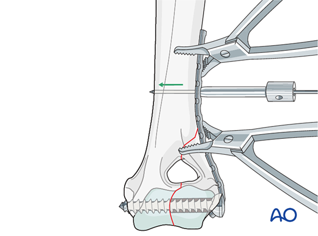 Transcondylar screw and plating of the epicondylar crest for Lateral ...