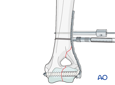 Transcondylar screw and plating of the epicondylar crest for Lateral ...