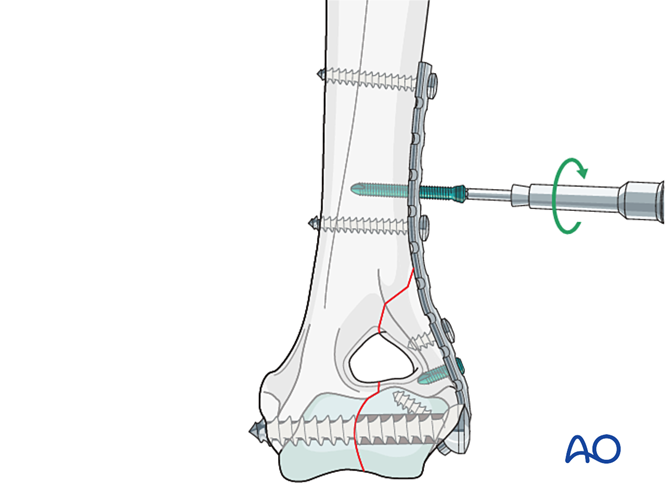 Transcondylar screw and plating of the epicondylar crest for Lateral ...