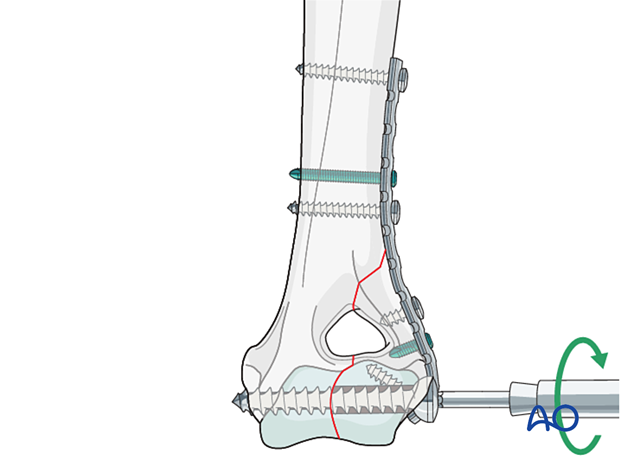 Transcondylar screw and plating of the epicondylar crest for Lateral ...