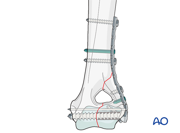 Transcondylar screw and plating of the epicondylar crest for Lateral ...