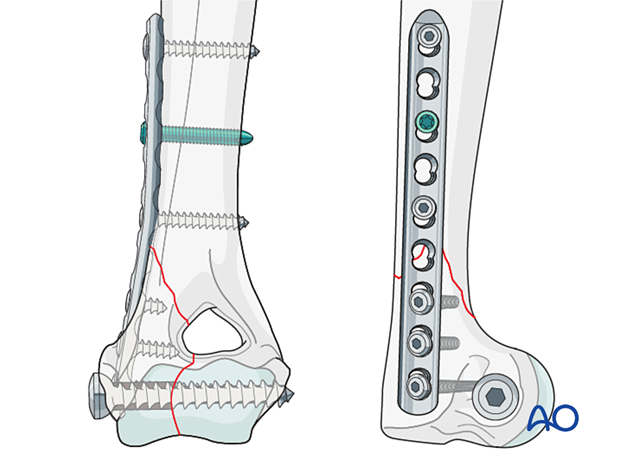 Transcondylar screw and plating of epicondylar crest for Introduction