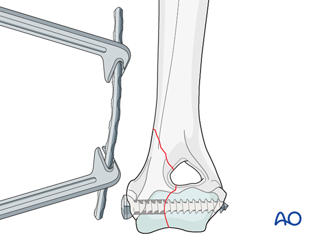 Transcondylar screw and plating of epicondylar crest for Introduction