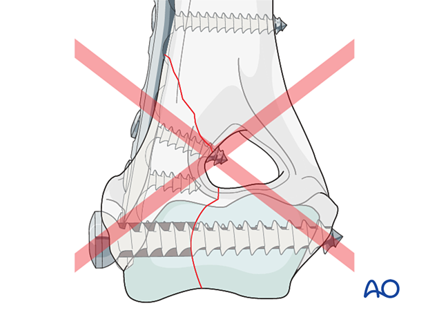 Transcondylar screw and plating of epicondylar crest for Introduction