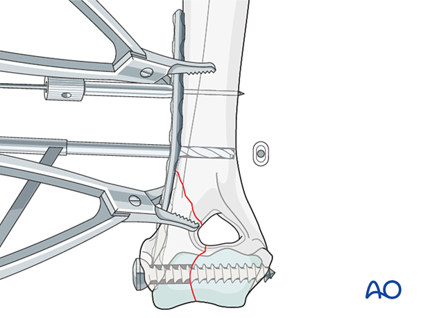 Transcondylar screw and plating of epicondylar crest for Introduction