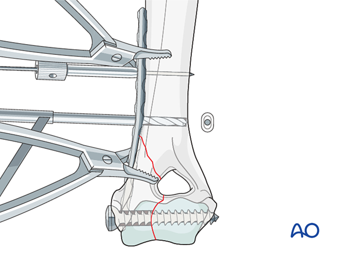 Transcondylar screw and plating of epicondylar crest for Introduction