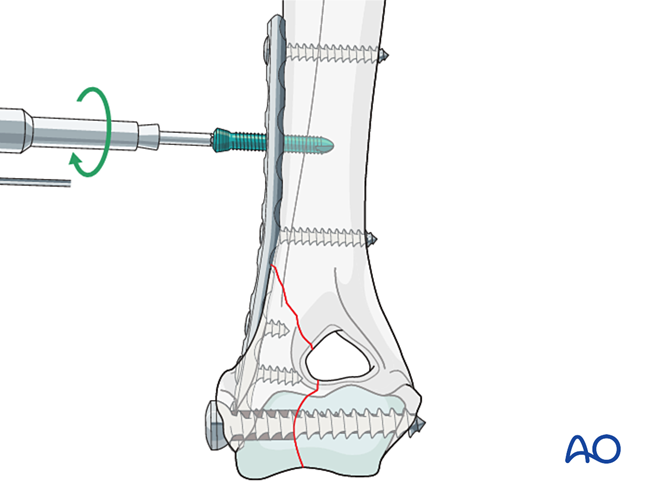 Transcondylar screw and plating of epicondylar crest for Introduction