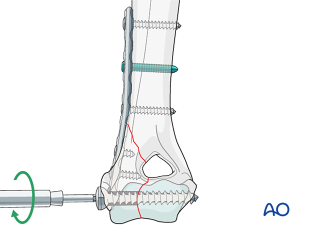 Transcondylar screw and plating of epicondylar crest for Introduction