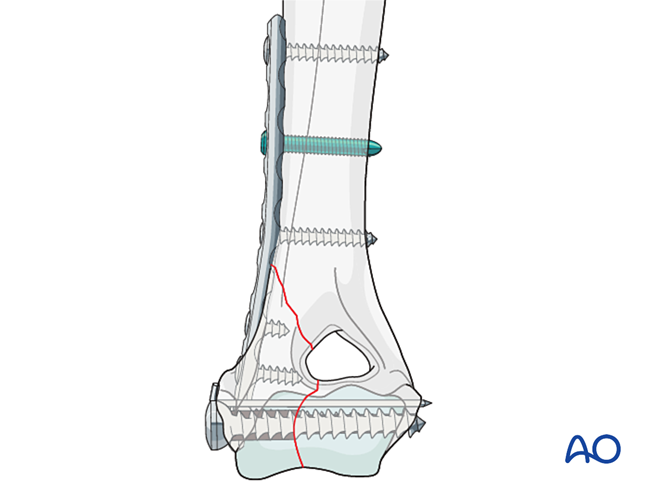 Transcondylar screw and plating of epicondylar crest for Introduction