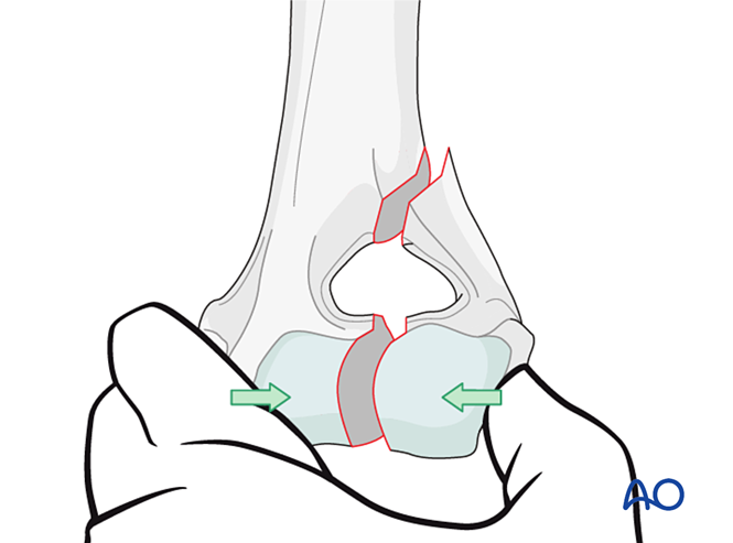 Crossed transcondylar K-wires and antirotational pin for Lateral ...