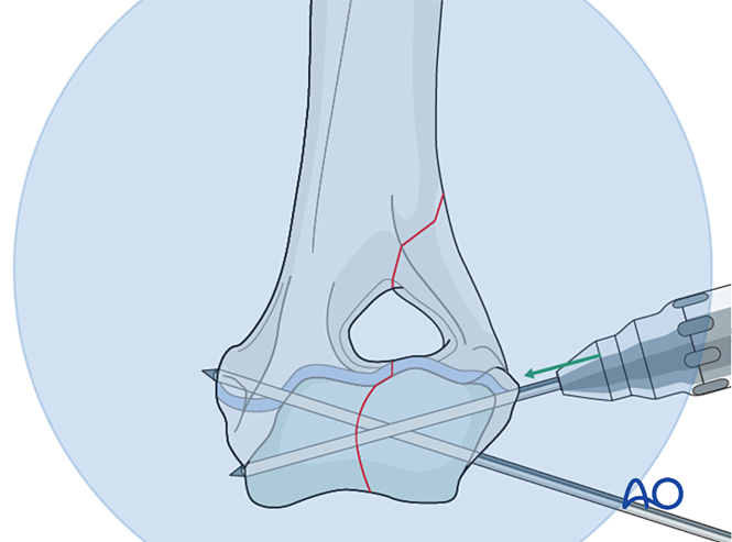 Crossed transcondylar K-wires and antirotational pin for Lateral ...