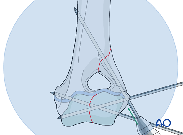 Crossed transcondylar K-wires and antirotational pin for Lateral ...