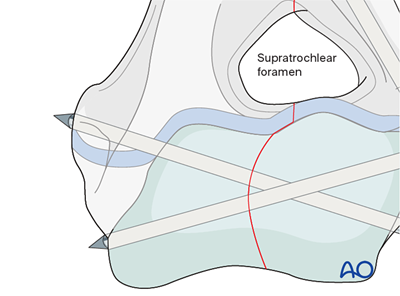 Crossed transcondylar K-wires and antirotational pin for Lateral ...