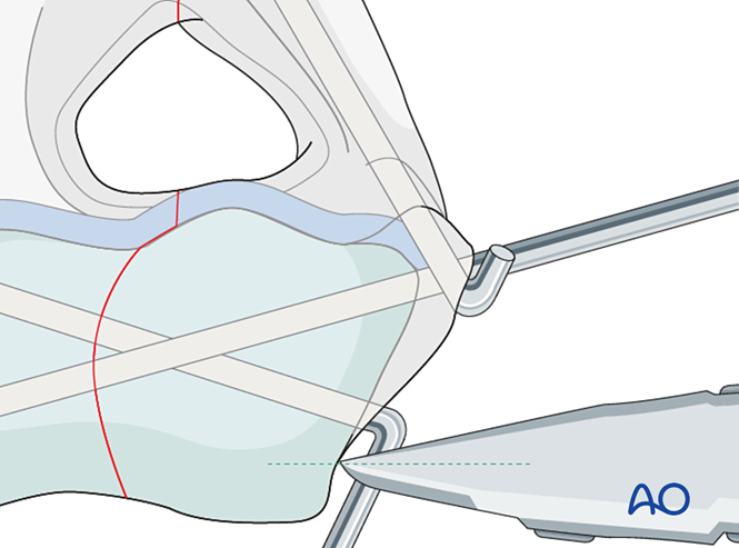 Crossed transcondylar K-wires and antirotational pin for Lateral ...