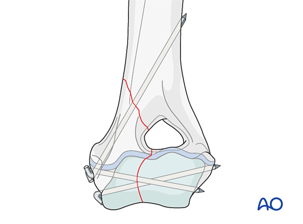 Crossed transcondylar K-wires and antirotational pin for Medial partial ...
